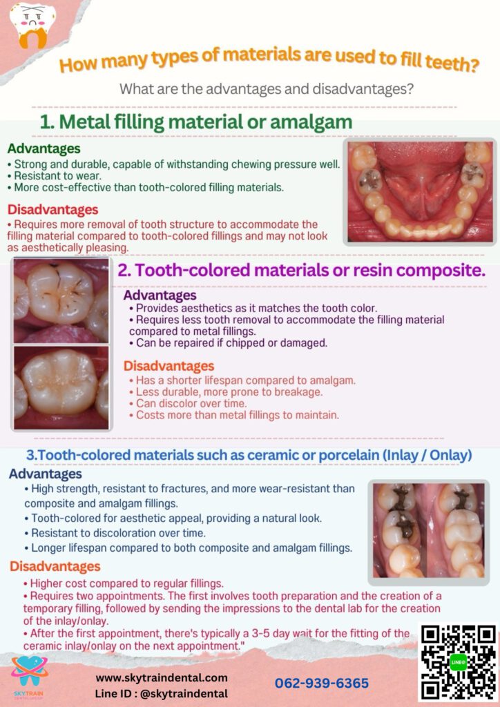 How many types of tooth filling materials are there? - Skytrain Dental