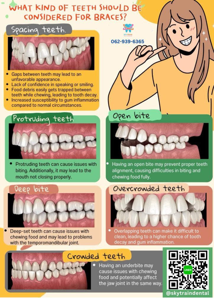 What type of teeth should have orthodontics? - Skytrain Dental
